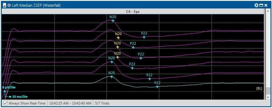 Cascade IOMAX IONM | Cadwell Intraoperative Neuromonitoring Equipment