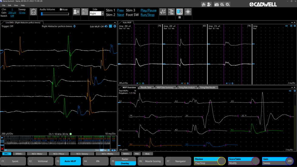 Sierra Software for dynamic Electrodiagnostic (EDX) Testing